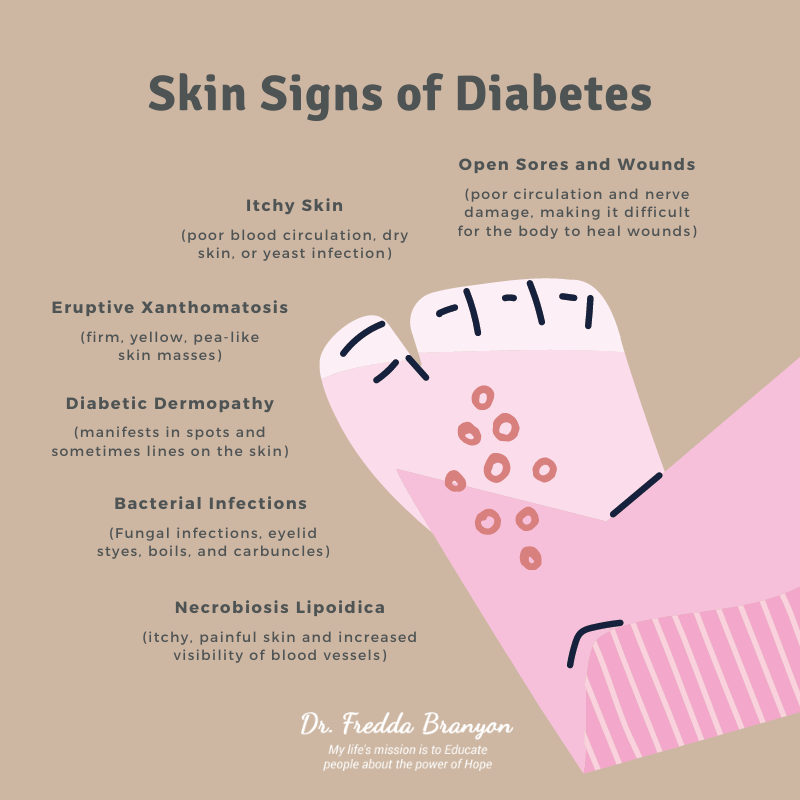 Your Skin and Diabetes | Fredda Branyon